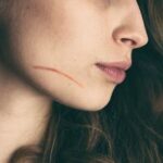 CICATRICES HIPERTRÓFICAS: Su Aspecto y Tratamiento - Para Cicatrices